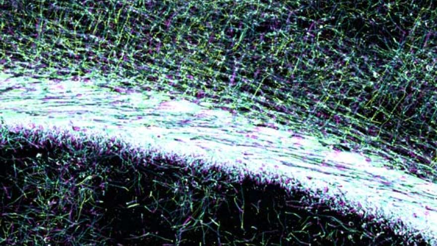 Could This New Drug Turn Back The Clock On Multiple Sclerosis Ucsf
